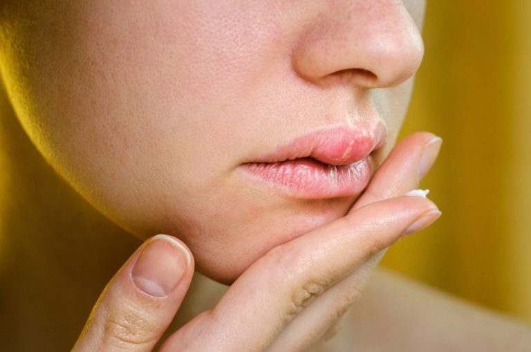 Swollen Lip On One Side: Causes, Symptoms, and Treatment